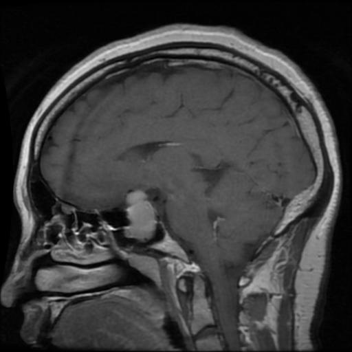 pituitary_train Object Detection Dataset by University