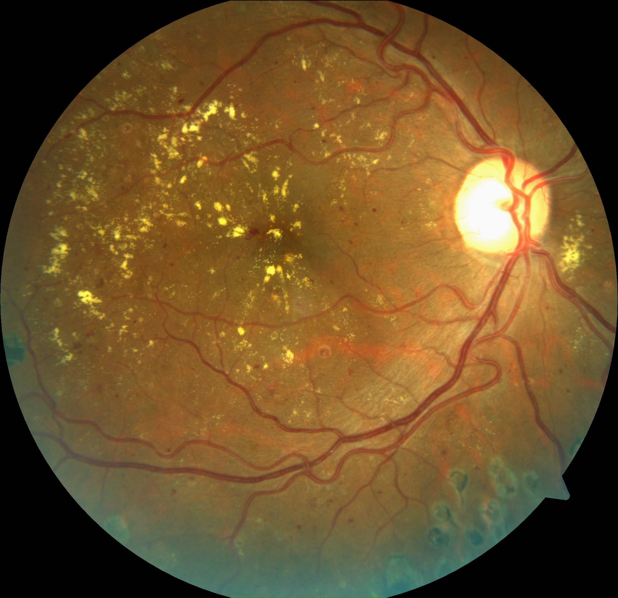 Diabetic-Retinopathy Classification Dataset by College