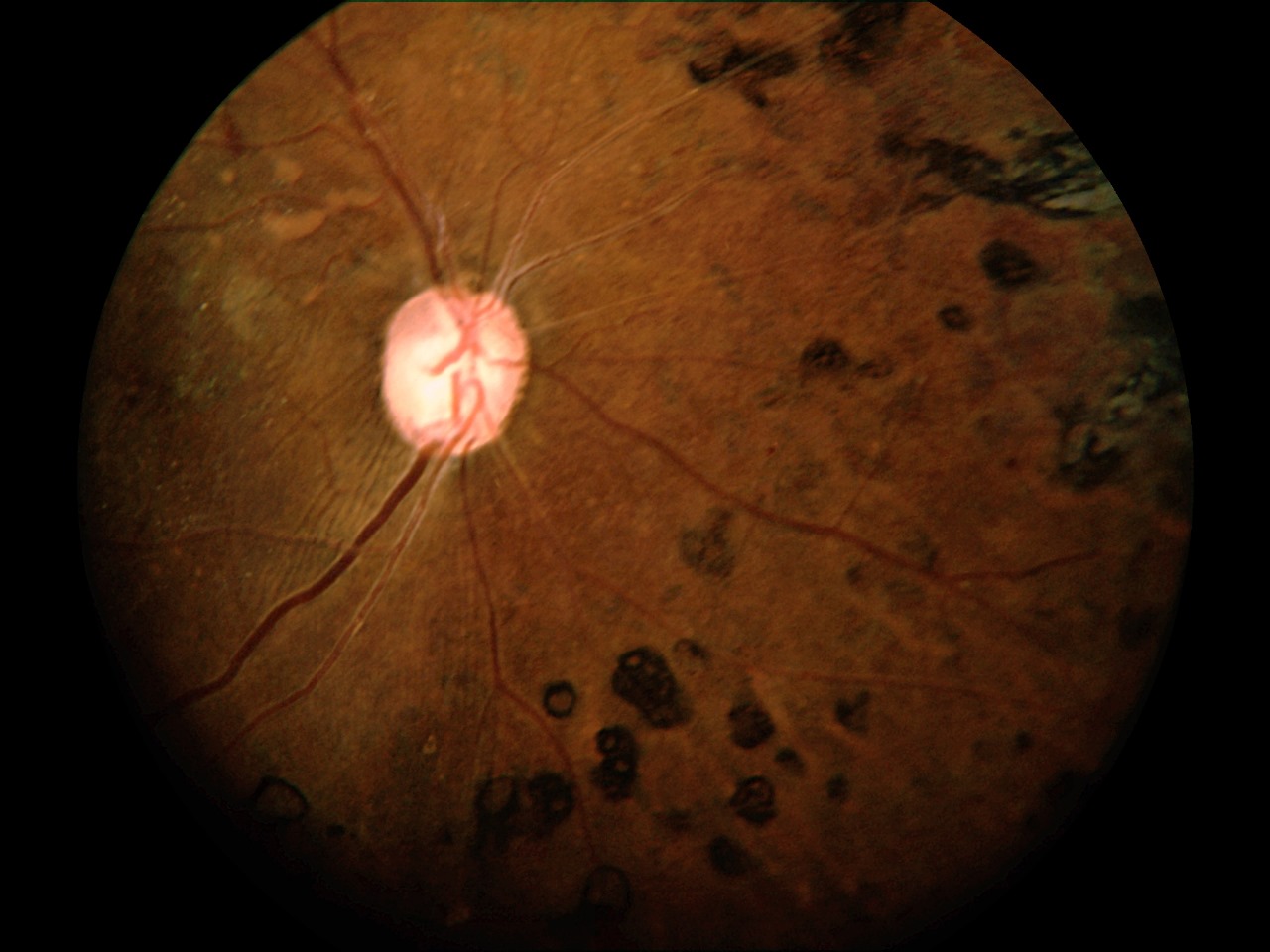 Optic_Cup Object Detection Model by retina scan
