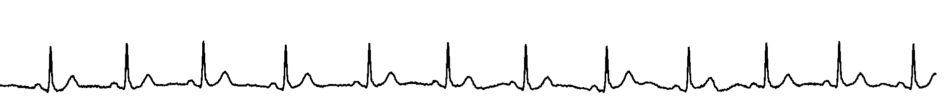 Ecg Detecting Roboflow Universe