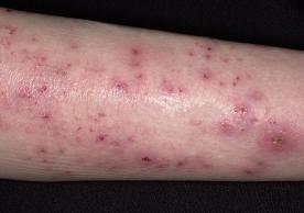 EczemaPsoriasis Object Detection Dataset by Dermnet