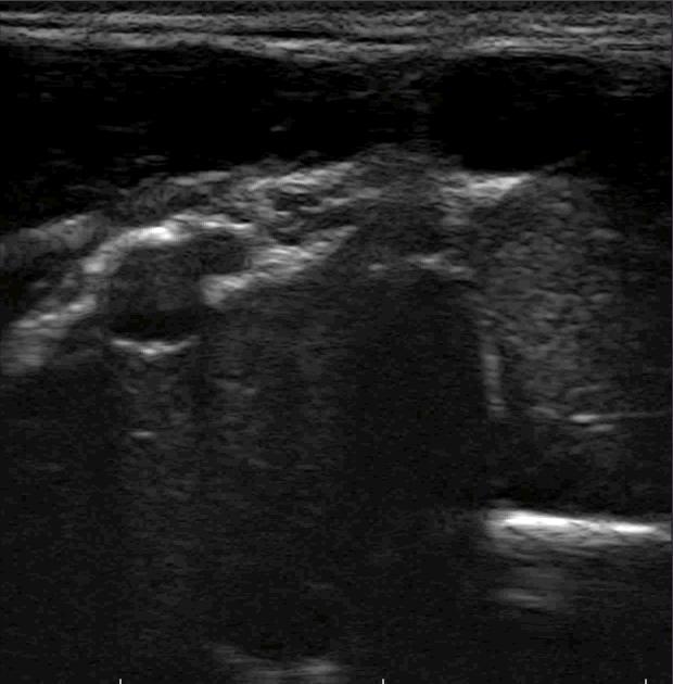 Ultrasound-basilic segmentation Instance Segmentation Dataset and Pre-Trained Model by Jas