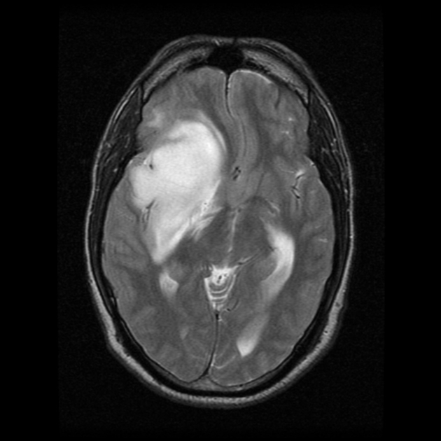 Brain Tumor Classification And Segmentation Instance Segmentation