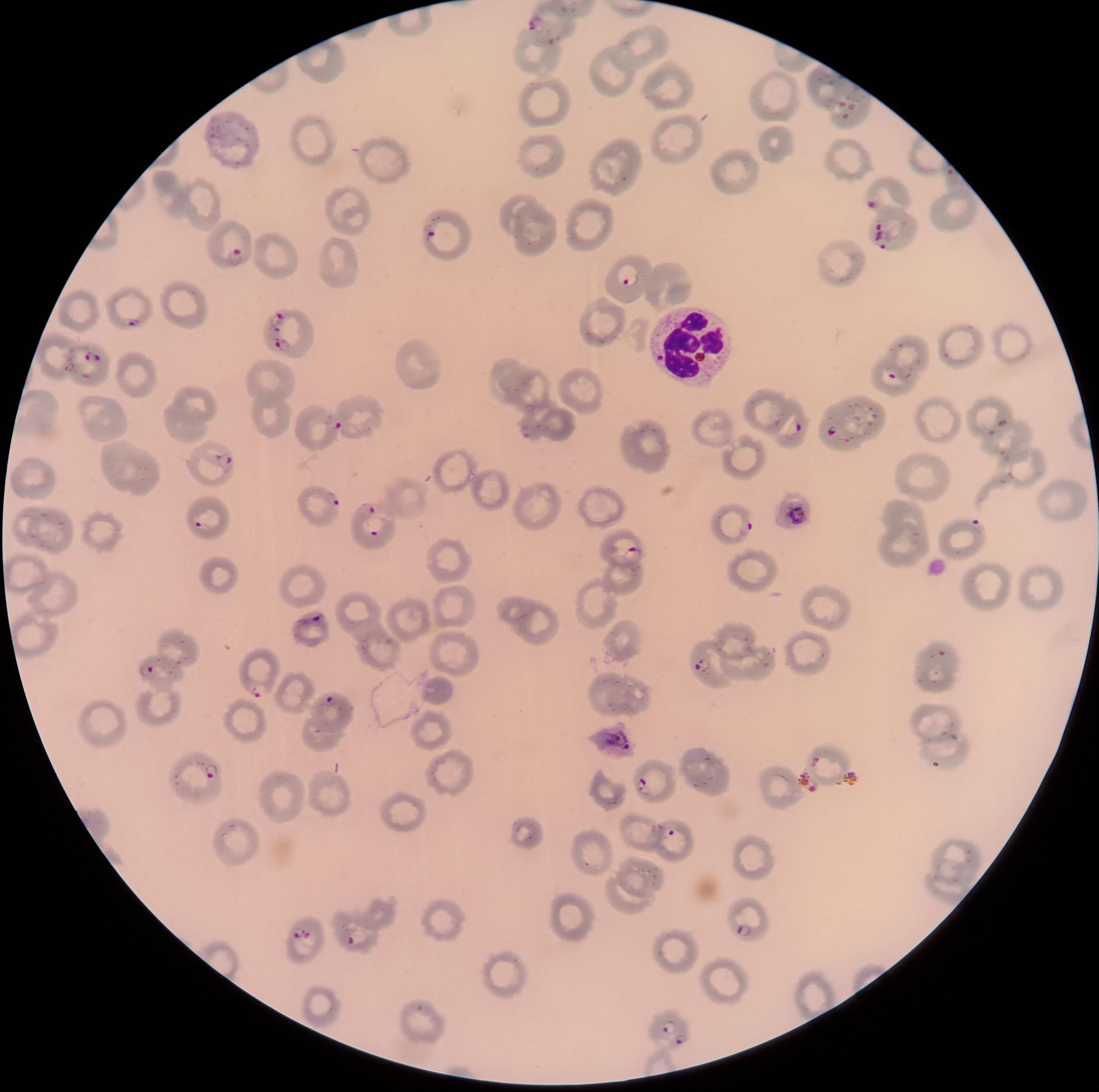 malaria_broadinstitute_diagmal Object Detection Dataset by Samisaid