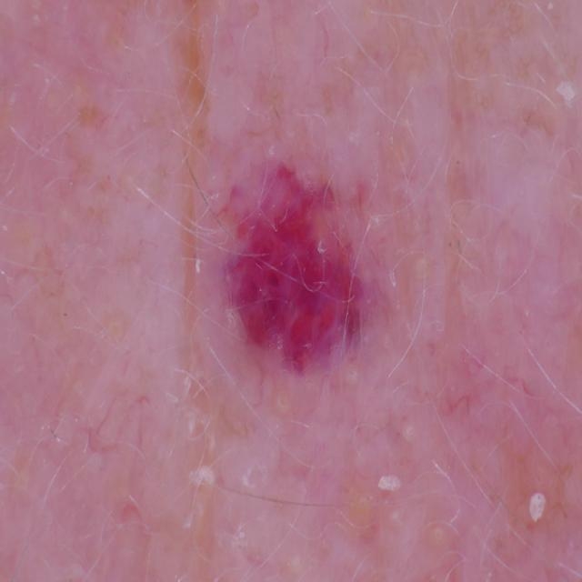 My HAM10000 Object Detection Dataset and Pre-Trained Model by MYHAM10000