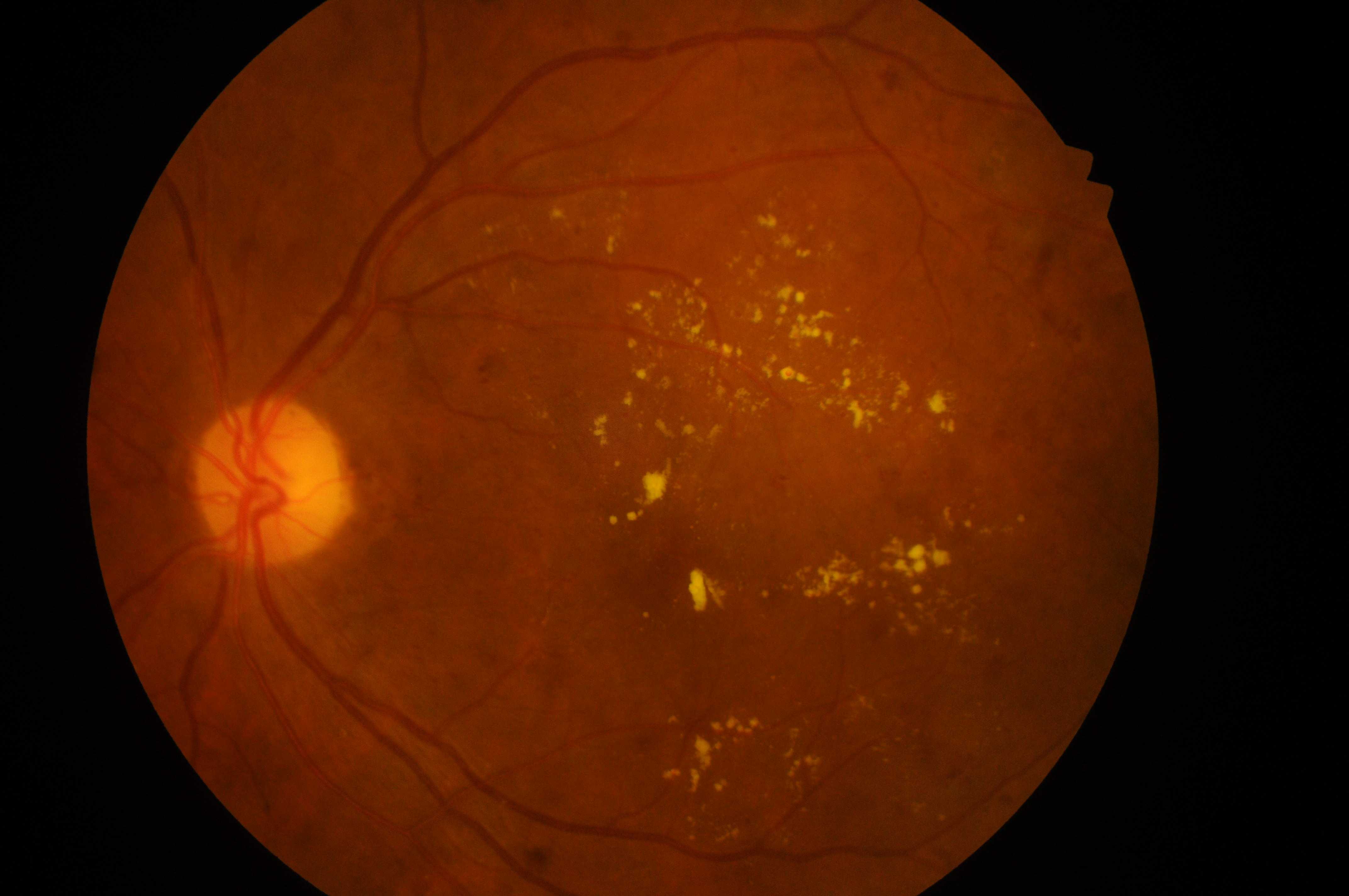 Retina Object Detection Model by retina