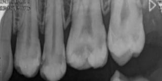 Dental Caries X-ray Instance Segmentation Model by Renielaz