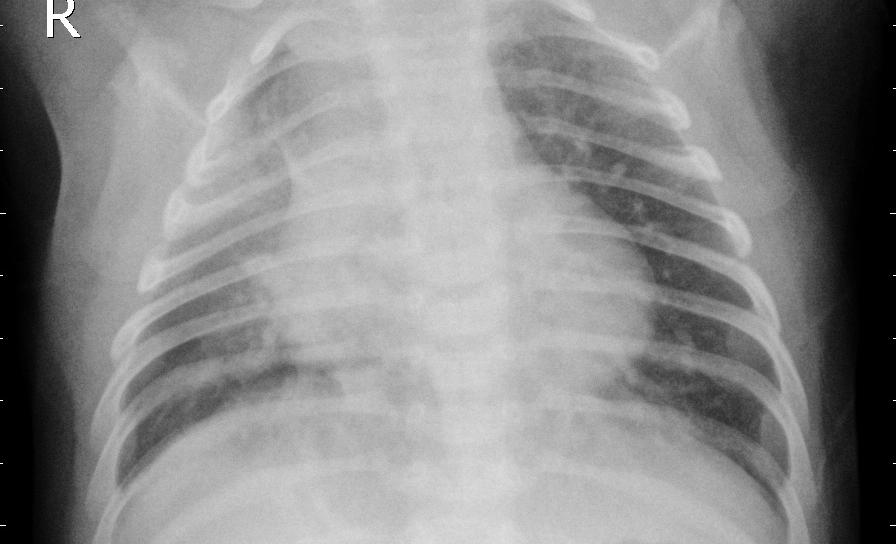 Pneumonia Detection Object Detection Dataset By Project Xchjh