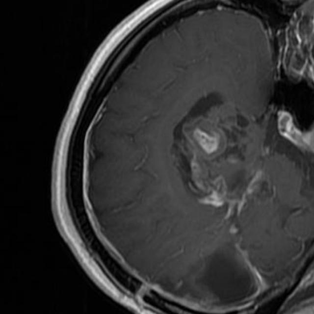 Tumor Otak Object Detection Dataset By Ta