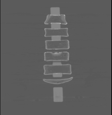 How to Use the Vertebrae 2 Instance Segmentation API