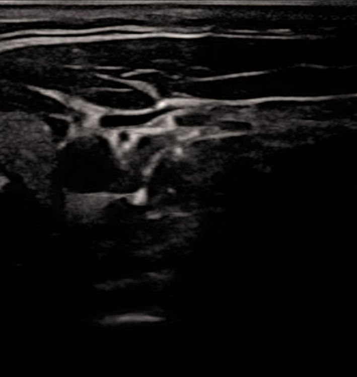 Carotid Artery Detect Instance Segmentation Dataset And Pre Trained Model By Heh