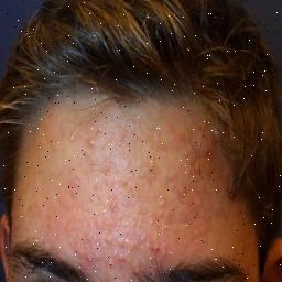 acne gan Object Detection Dataset by learning