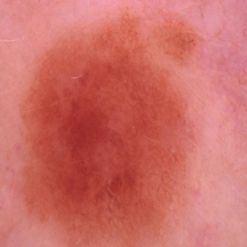 ISIC Skin Cancer Labeling Object Detection Dataset by Hobby