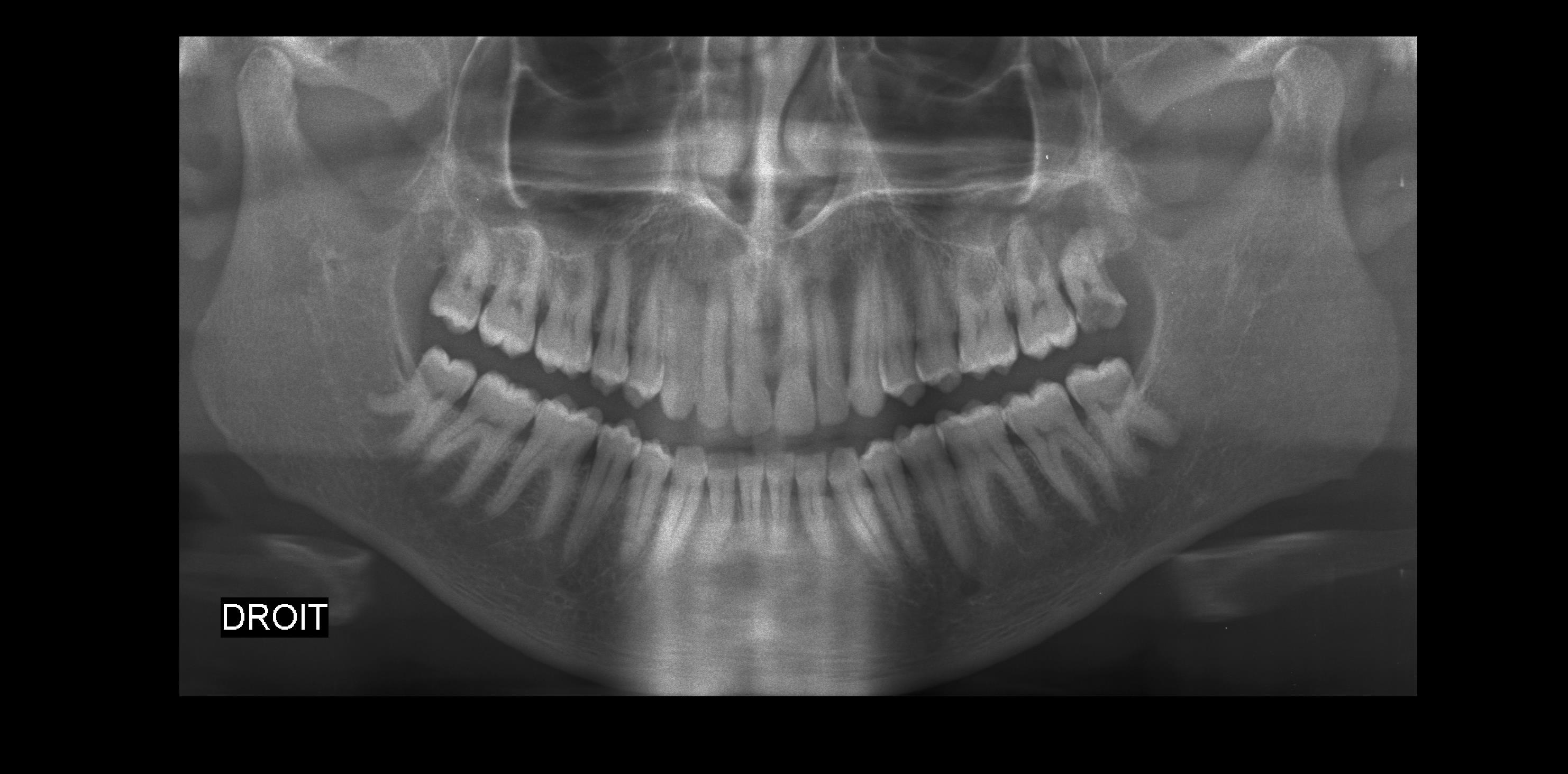 Panaromic Xray Detection Object Detection Dataset And Pre Trained Model
