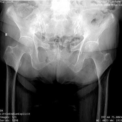 HIP-OSTEO Classification Model by Abinaya sri