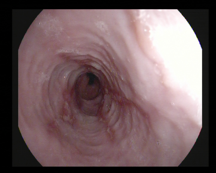 Esophagial Object Detection Object Detection Dataset By Sofi