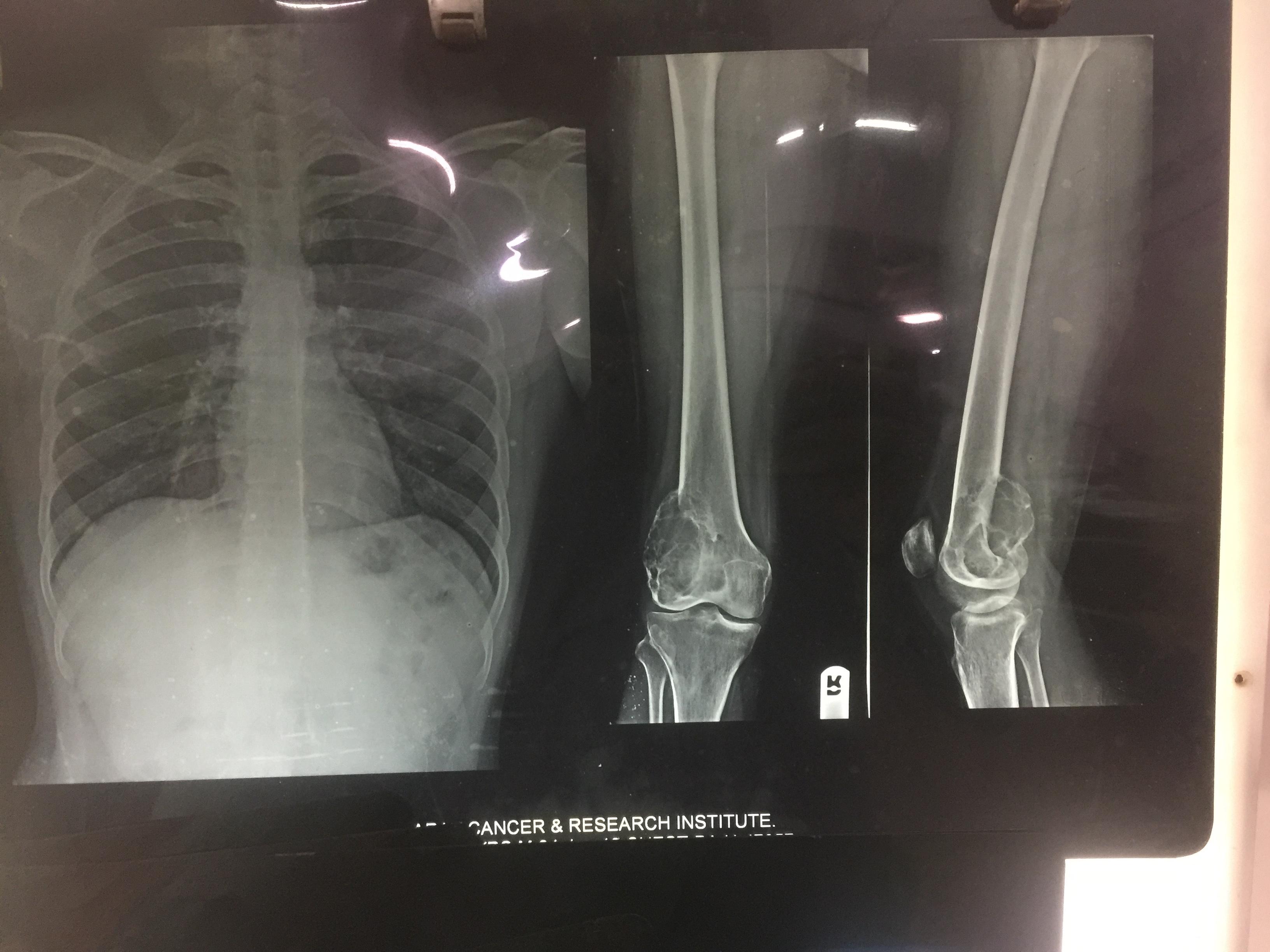 BoneSal Instance Segmentation Dataset by hello world