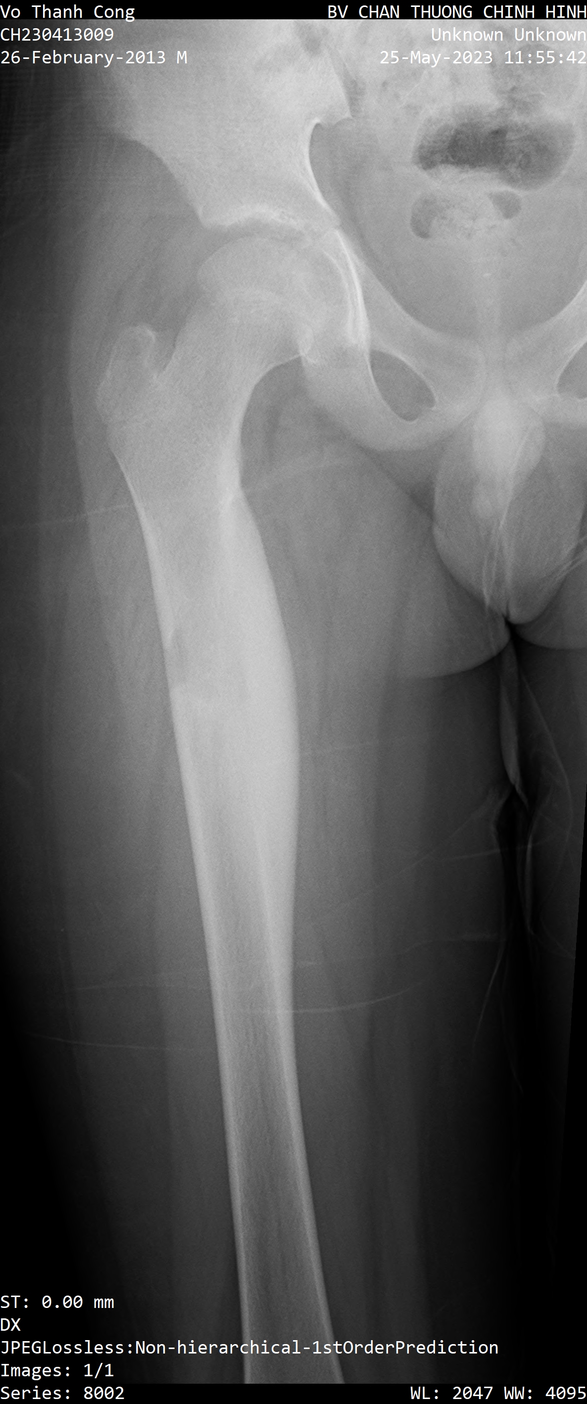 Bone Dataset 2 Instance Segmentation Dataset And Pre Trained Model By 1664