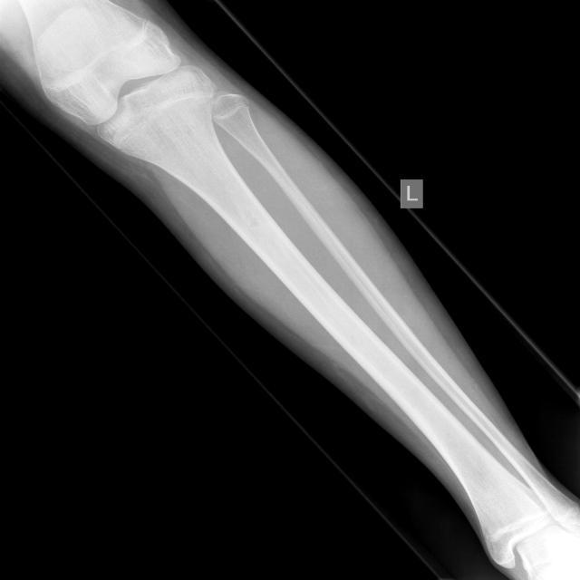 bone-v3-subtypes Instance Segmentation Dataset by hello world