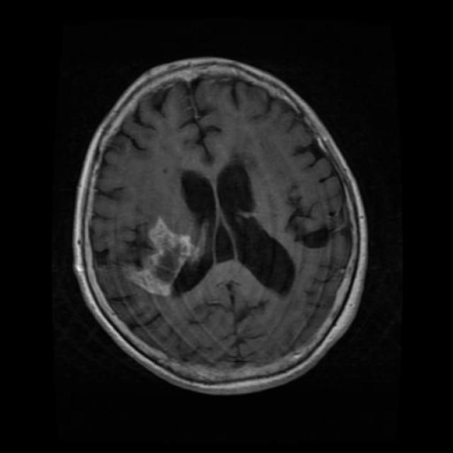 Brain Tumor Detection Brain Tumor Detection B2faq Roboflow Universe