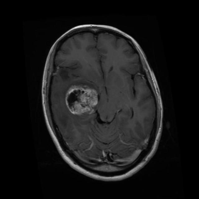 Mri Tumor Detection Object Detection Dataset And Pre Trained Model By