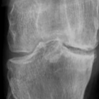 Knee Osteoarthritis Severity Detection 03 Object Detection Model By