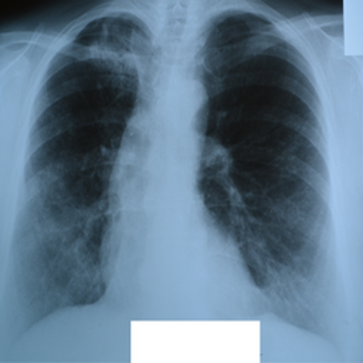 TB Classification Model by DiseasePredict
