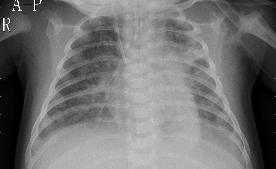 Pneumonia Classification Model by DiseasePredict
