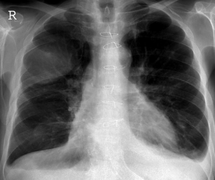 How to Use the chest x ray Instance Segmentation API