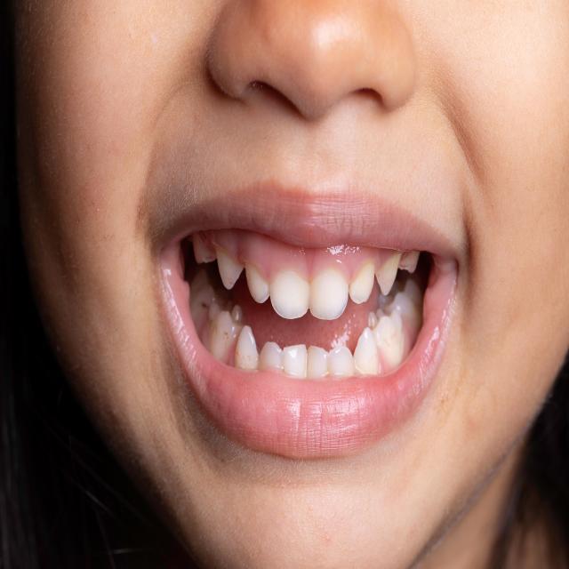 caries detection Object Detection Dataset by Anodin