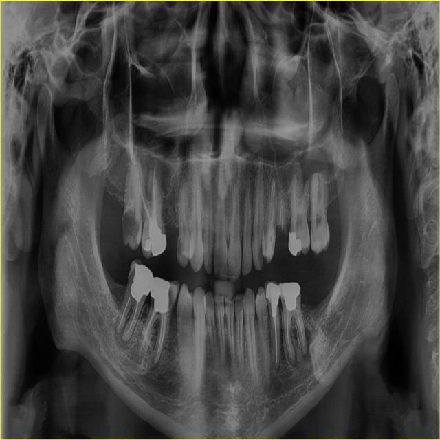 Teeth Detection 2 Instance Segmentation Dataset By Tooth Detection