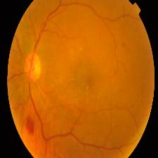 Diabetic Retinopathy Screening AI Classification Model by UCLA Master ...