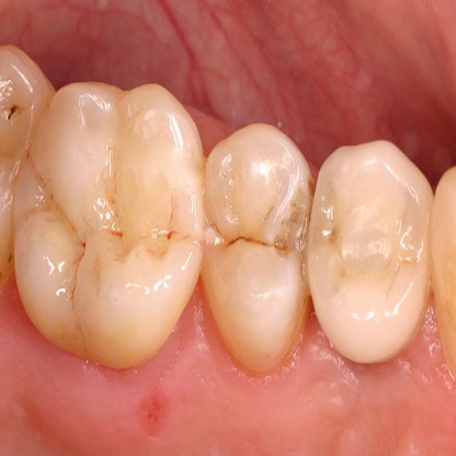 curuk_dis_fazla Object Detection Dataset by ibrahim Biner