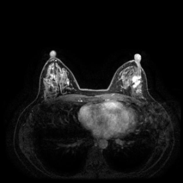 breast cancer MRI Object Detection Dataset by YOLO