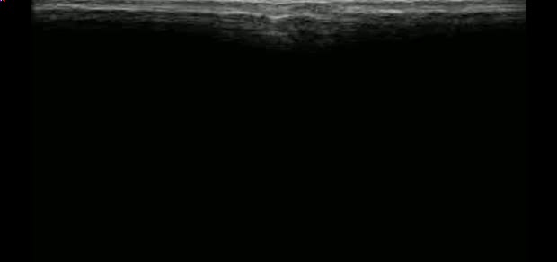 Final Vein Finder Object Detection Dataset by IVJector AI