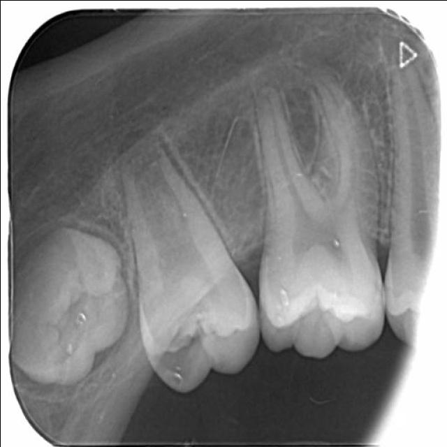 box_periapical_lesion Object Detection Model by SarahsModel