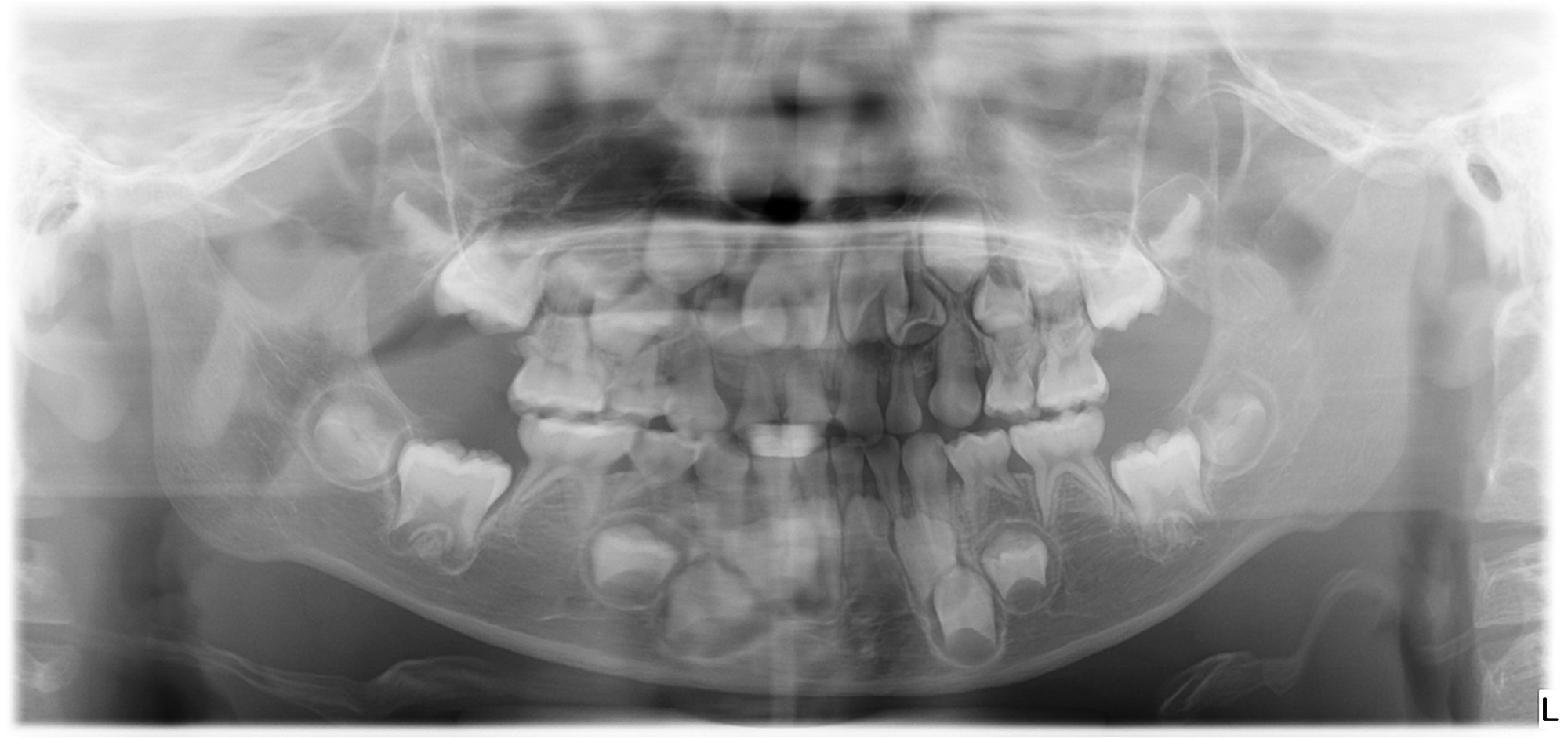 Children Dental Panaromic graphs Object Detection Dataset by Emmett