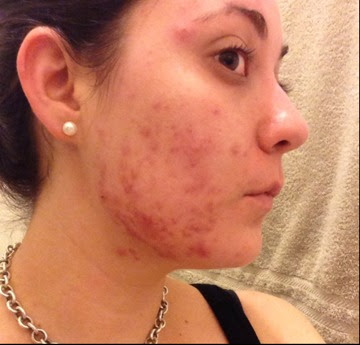 Acne Object Detection Dataset by devil