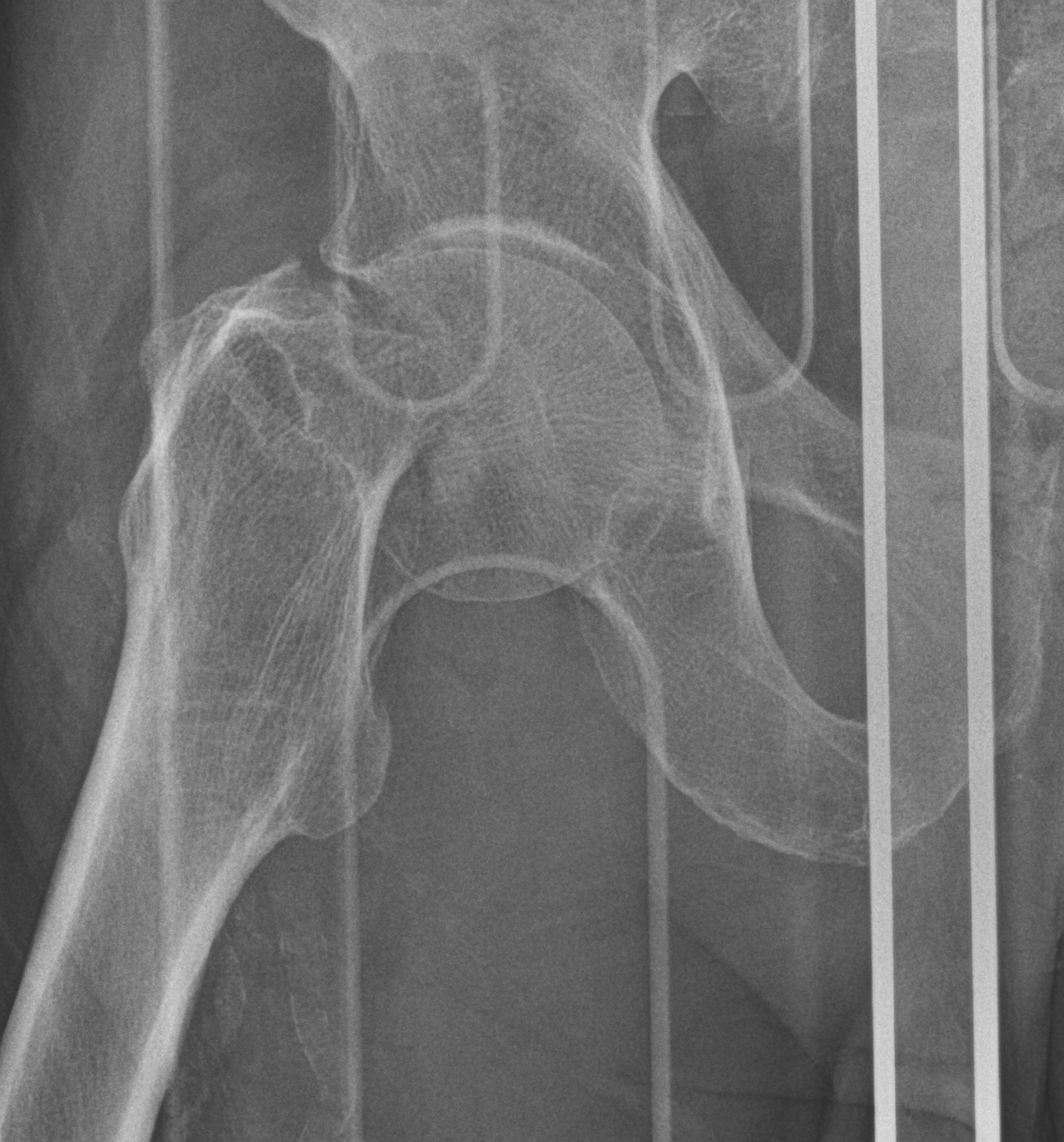 femur fracture classification Classification Model by Salih
