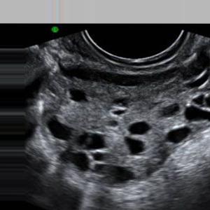 pcos detection Object Detection Dataset by project