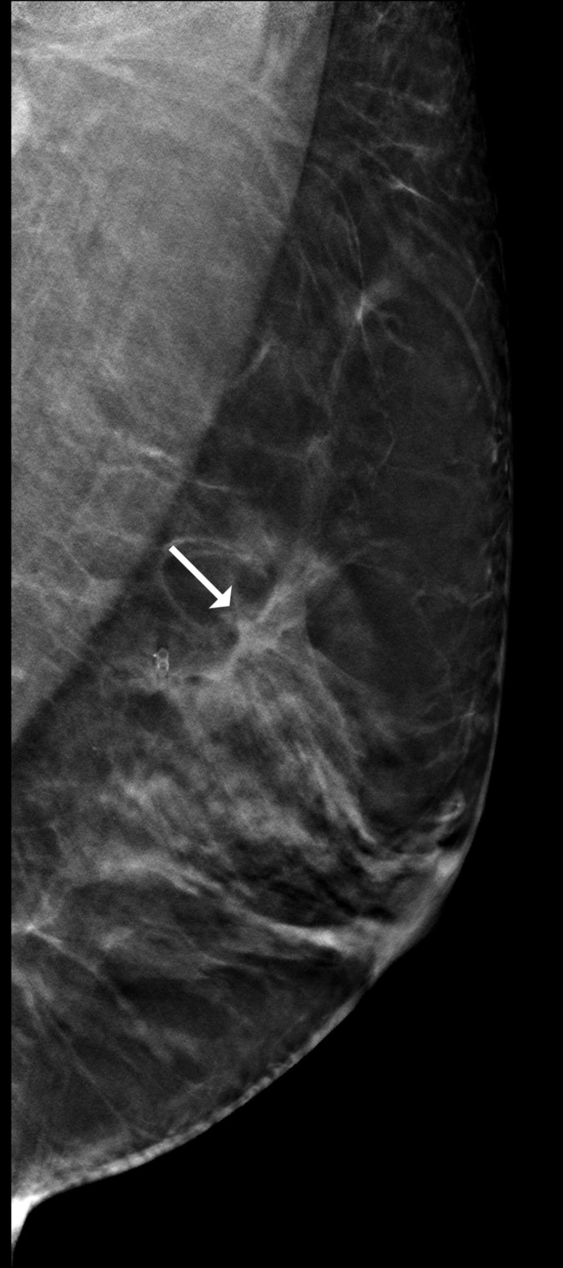 breast cancer and milkduct Object Detection Dataset by breastCancer
