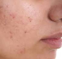 acne Object Detection Model by university