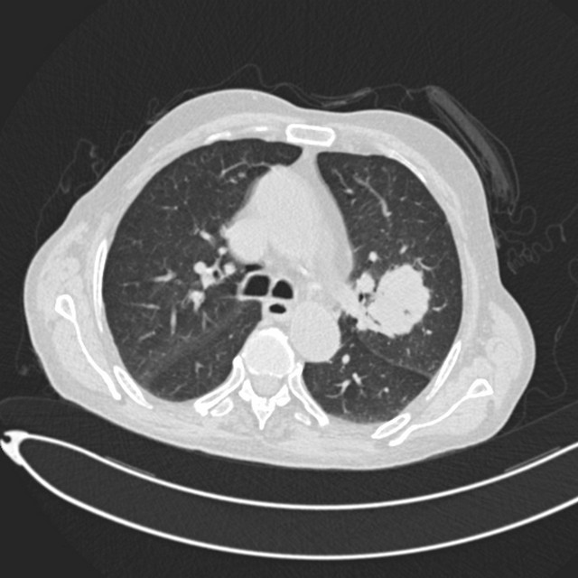 Object Detection Lung Cancer Object Detection Model by Setya Ilham