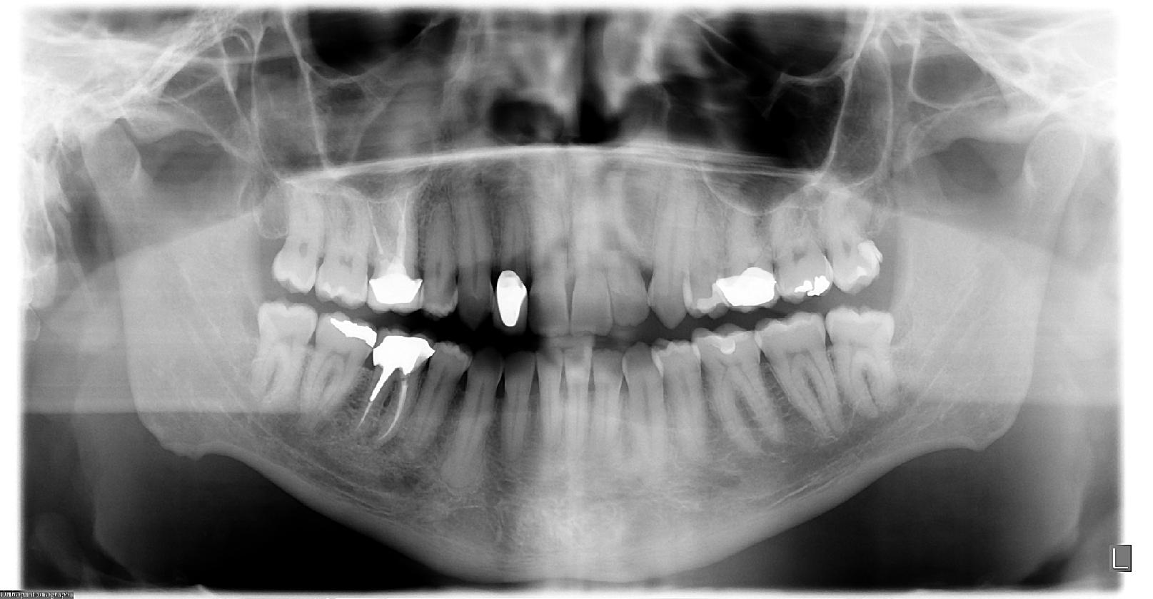 Ninna OPG Teeth Segmentation Instance Segmentation Dataset by ...