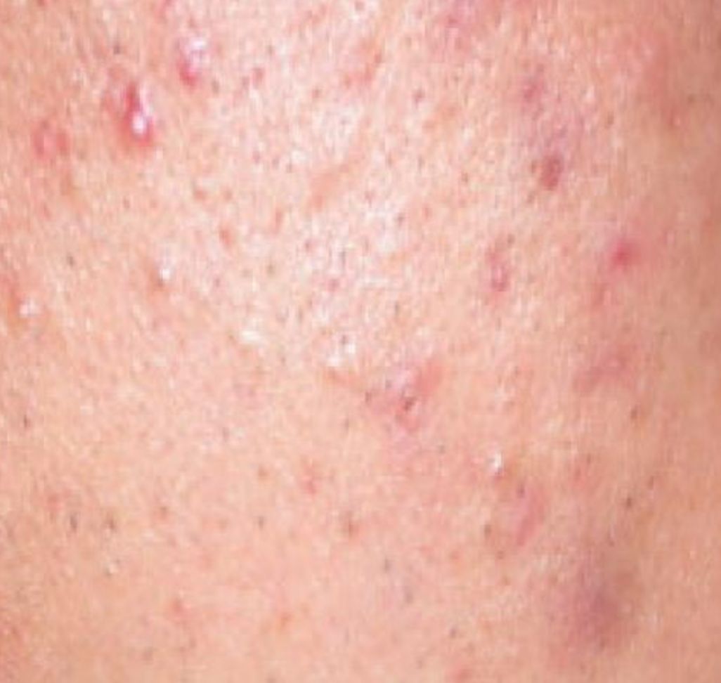 acne detection Object Detection Dataset by Emulxion