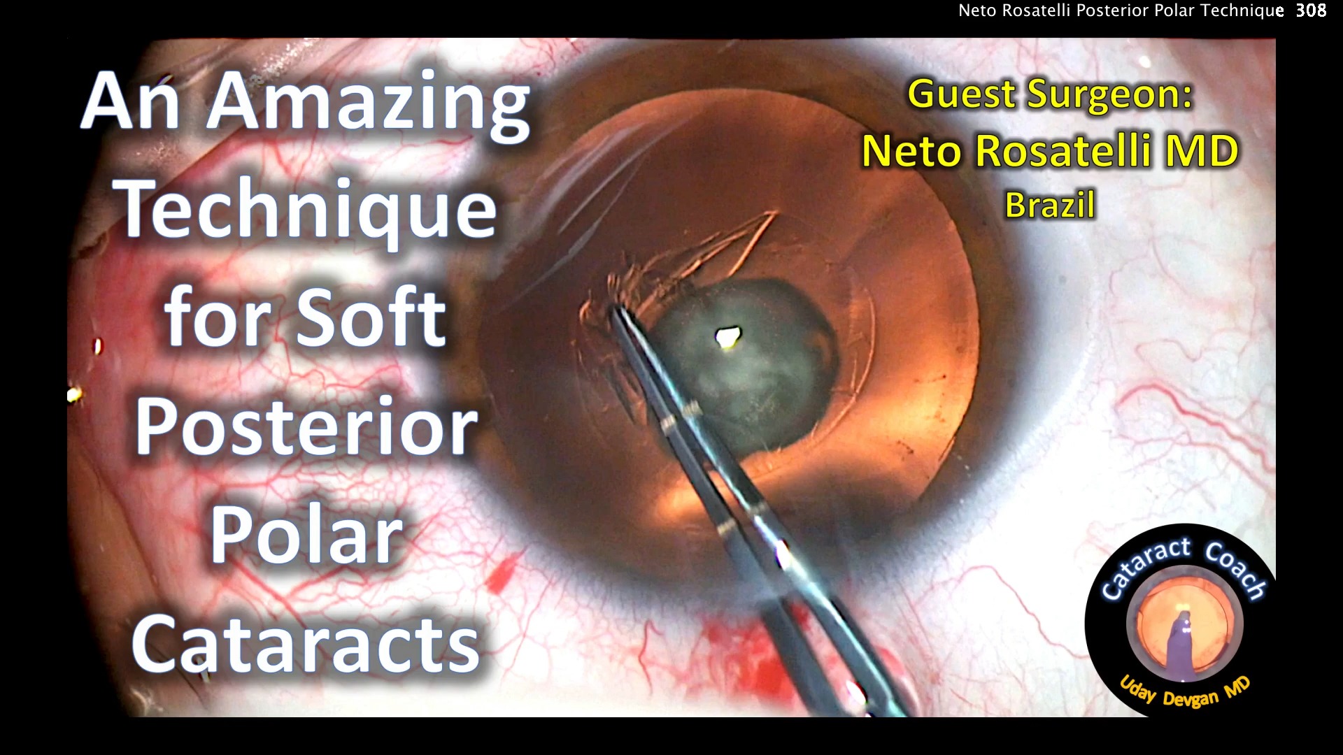 K_CC_amazing technique Instance Segmentation Dataset by AI Cataract Surgery Kenric