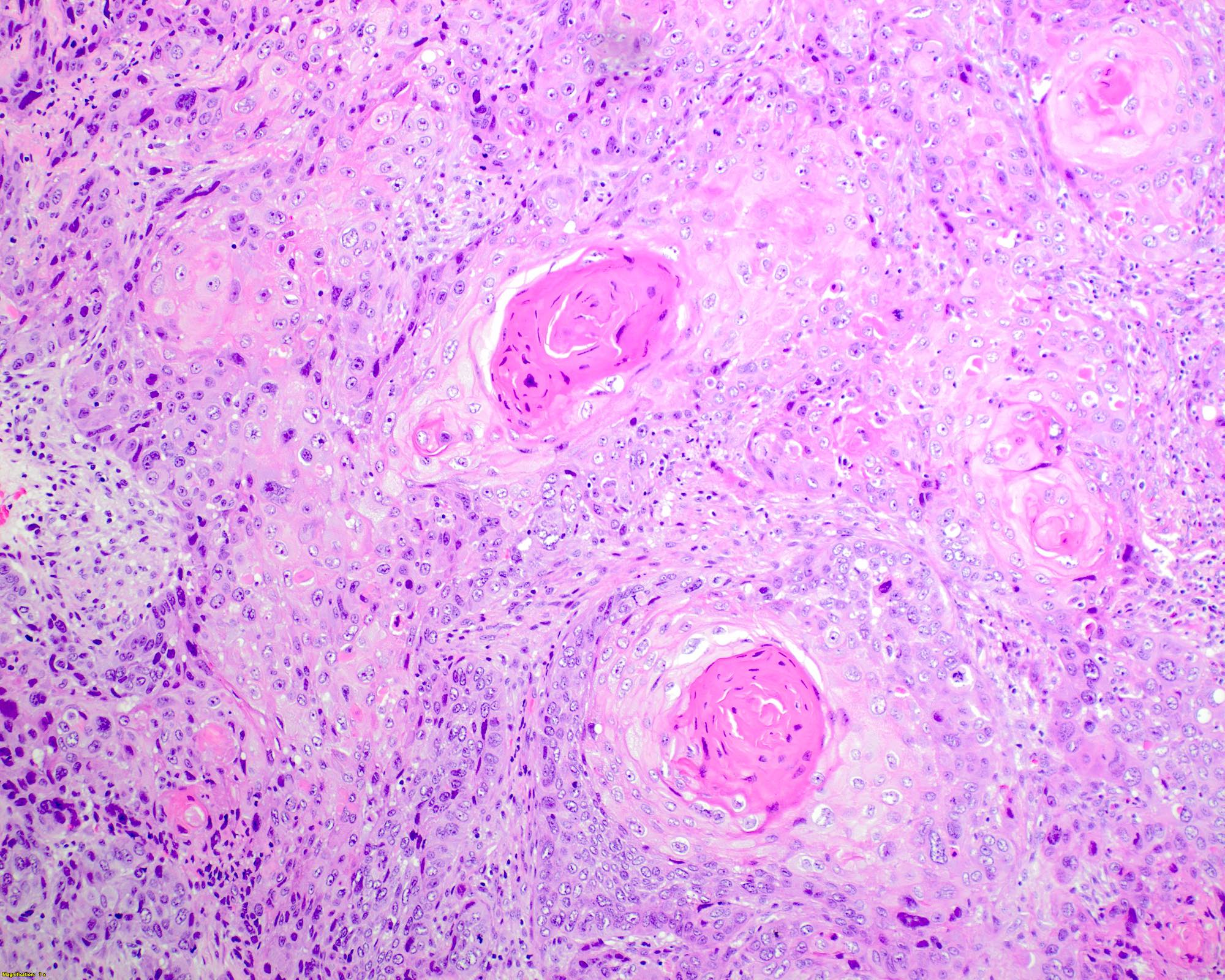 Squamous Cell Lung Carcinoma Object Detection Model by Pathology