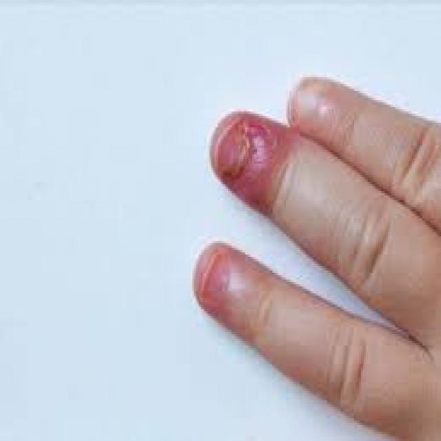 Wound_Detection Classification Dataset by OpenCV Tutorial