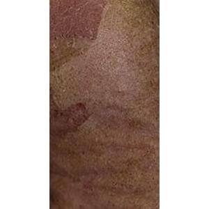 Skin Diseases Classification Dataset by OpenCV Tutorial