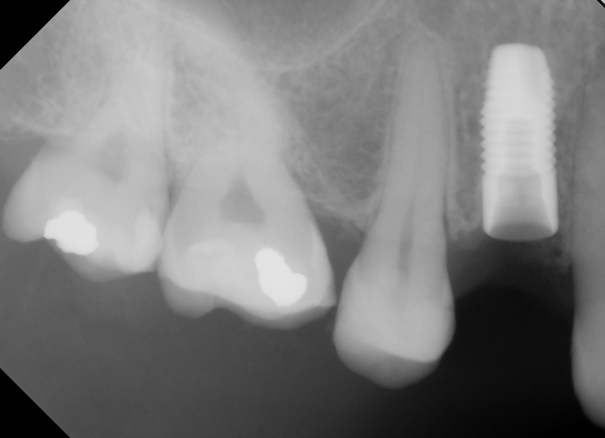 Implant data collection Object Detection Dataset by Ayezan Solutions